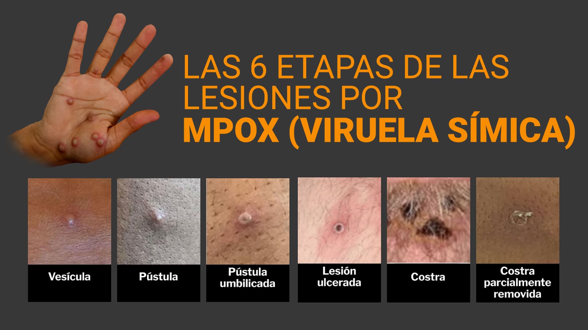 Viruela símica / Mpox – OSOSS